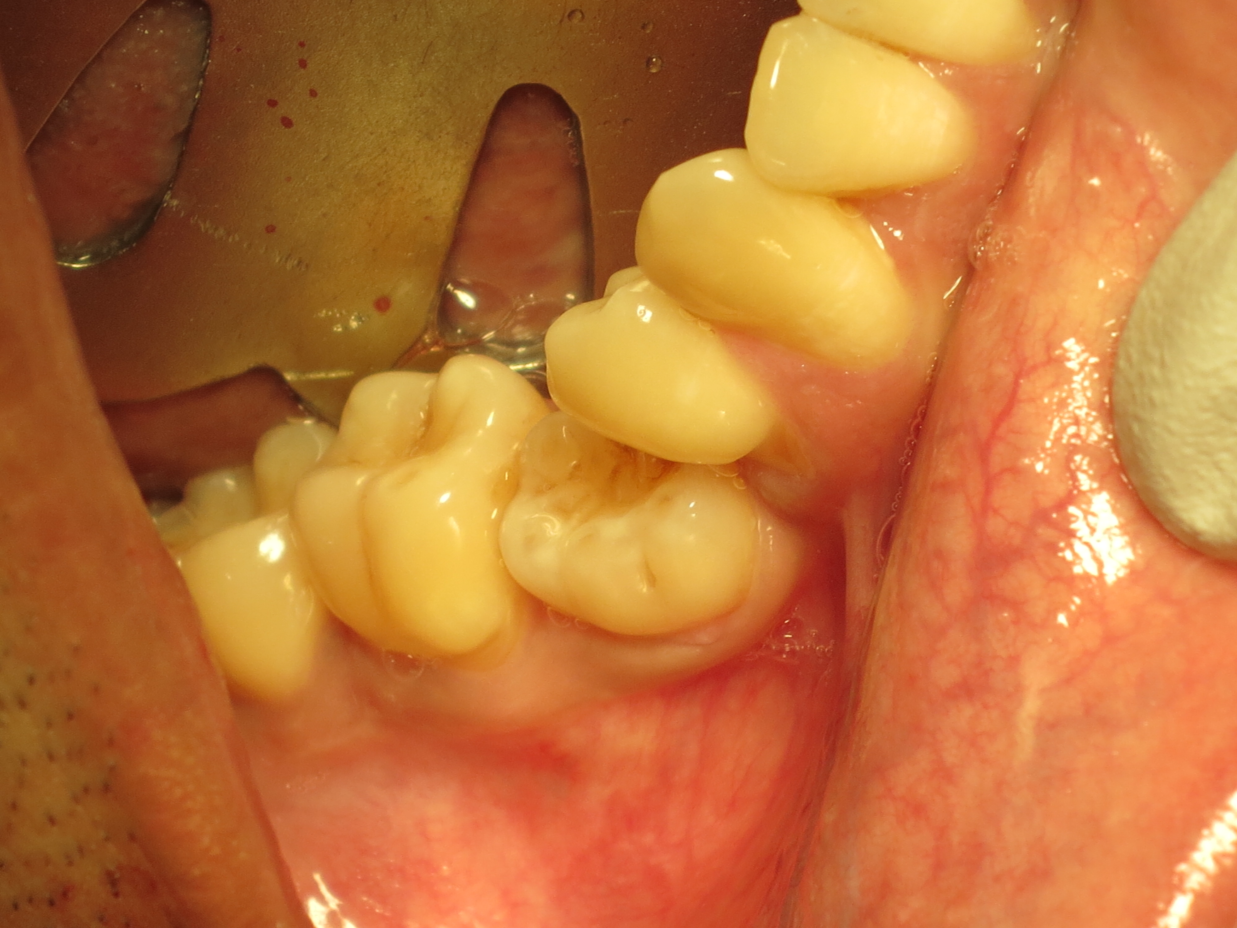 Management Of Ankylosed Primary Molars With Premolar Successors Aka
