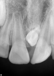 Panorex! Whats a panorex? Why do I need that? - Bay Area Surgical Arts