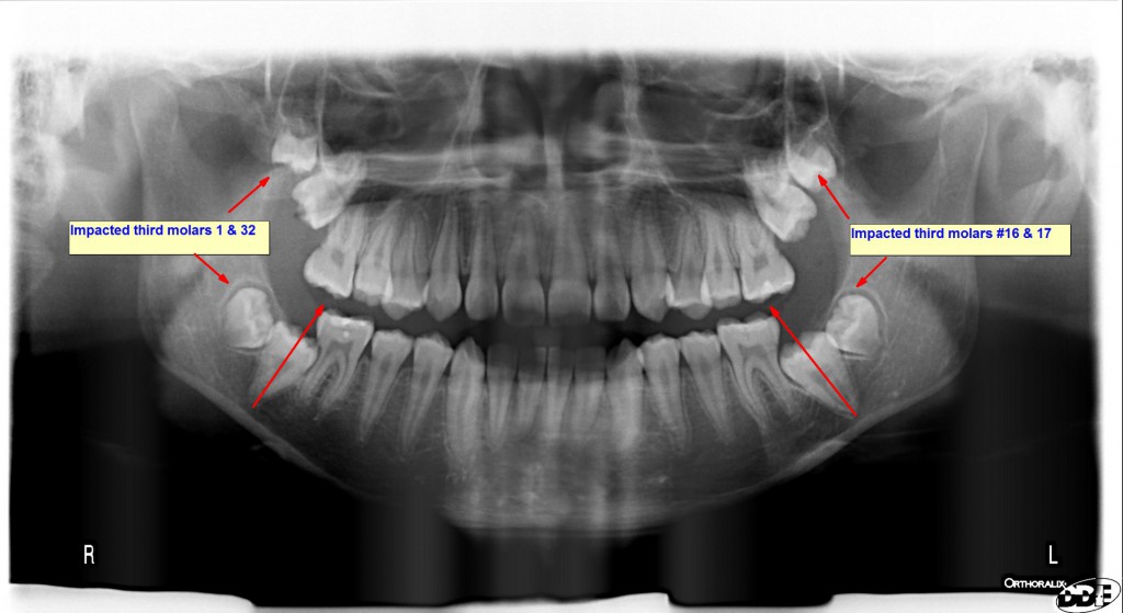 Panorex! Whats a panorex? Why do I need that? - Bay Area Surgical Arts