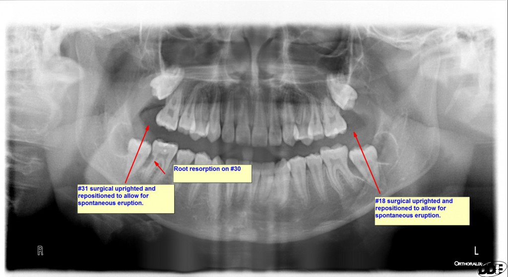 Panorex! Whats a panorex? Why do I need that? - Bay Area Surgical Arts