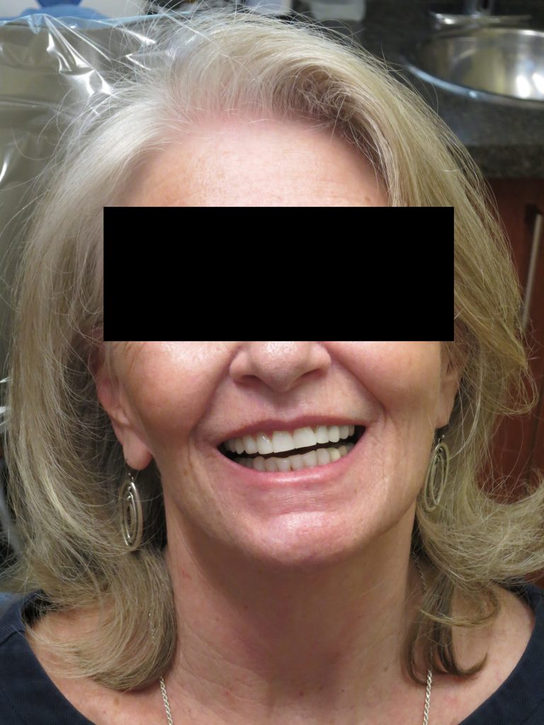 All About Jaw Fractures - Bay Area Surgical Arts