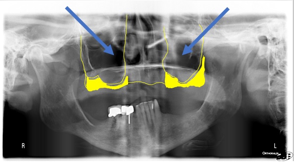 Sinus Lifts and Dental Implants - Bay Area Surgical Arts