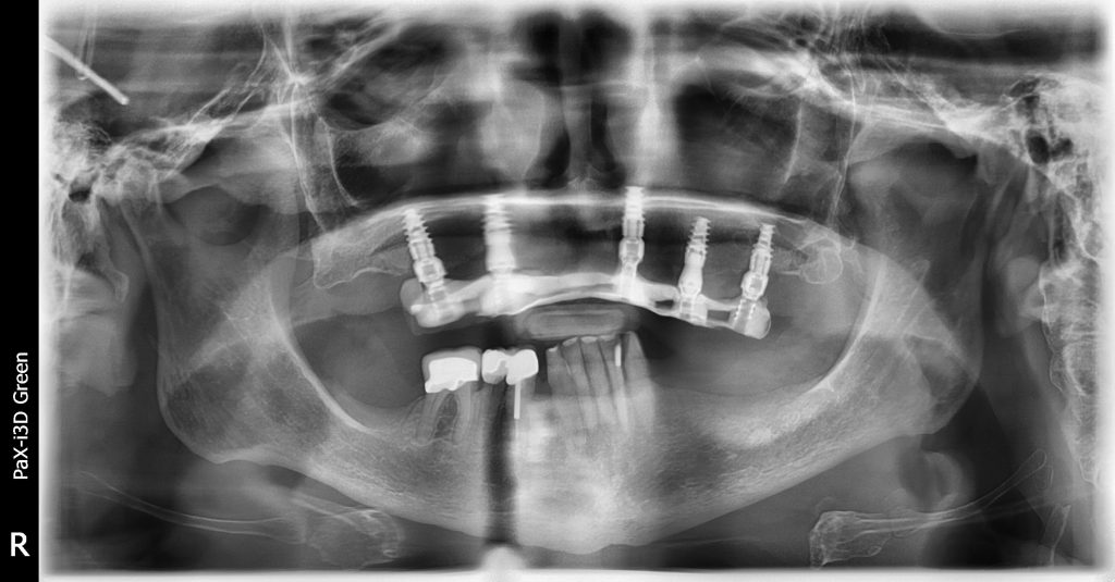 Sinus Lifts and Dental Implants - Bay Area Surgical Arts