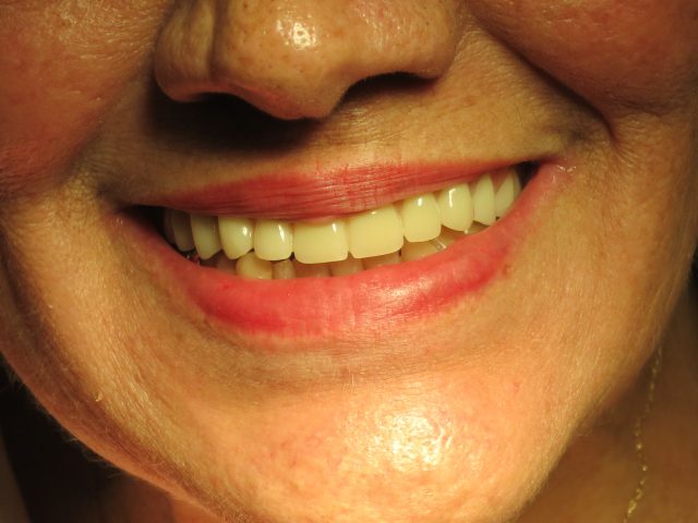Sinus Lifts And Dental Implants Dr Nima Massoomi Dmd Med Md