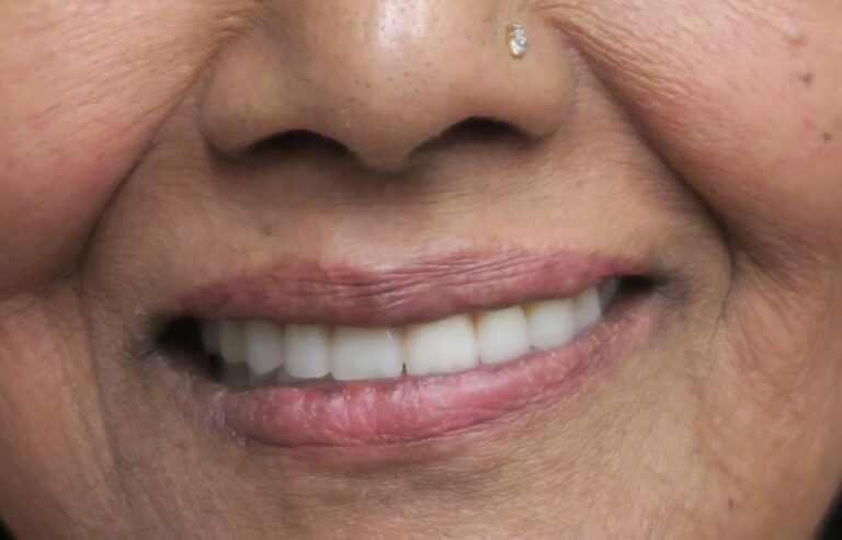 Benefits Of Full Arch Dental Implants Dr Nima Massoomi Dmd Med Md