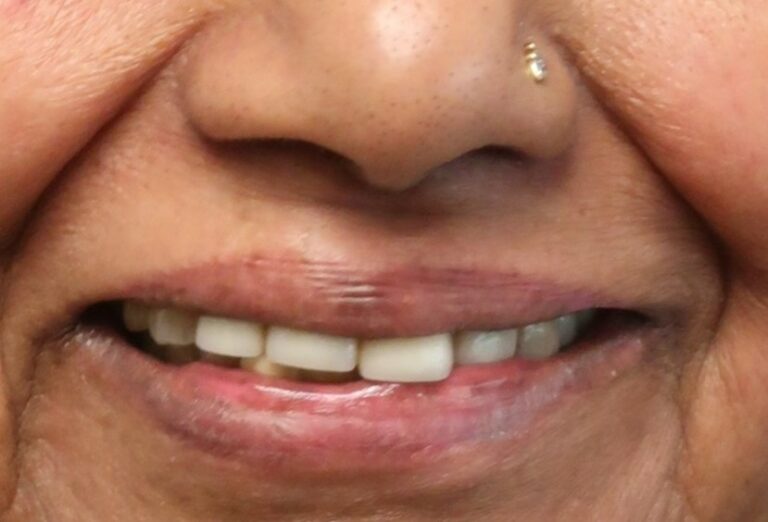 Benefits Of Full Arch Dental Implants Dr Nima Massoomi Dmd Med Md